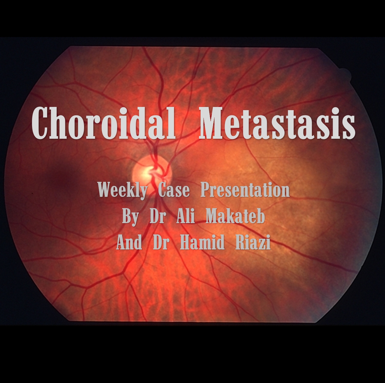 Choroidal Metastasis